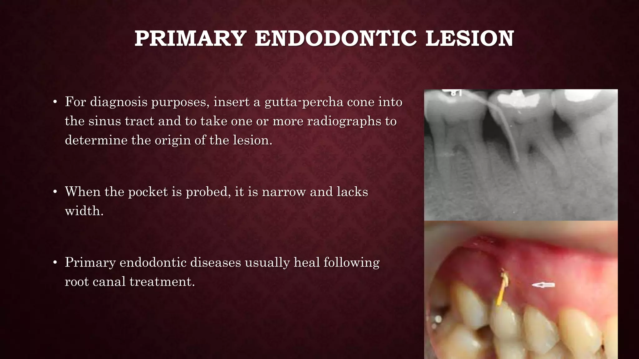Endo-Perio Lesions | PPTX
