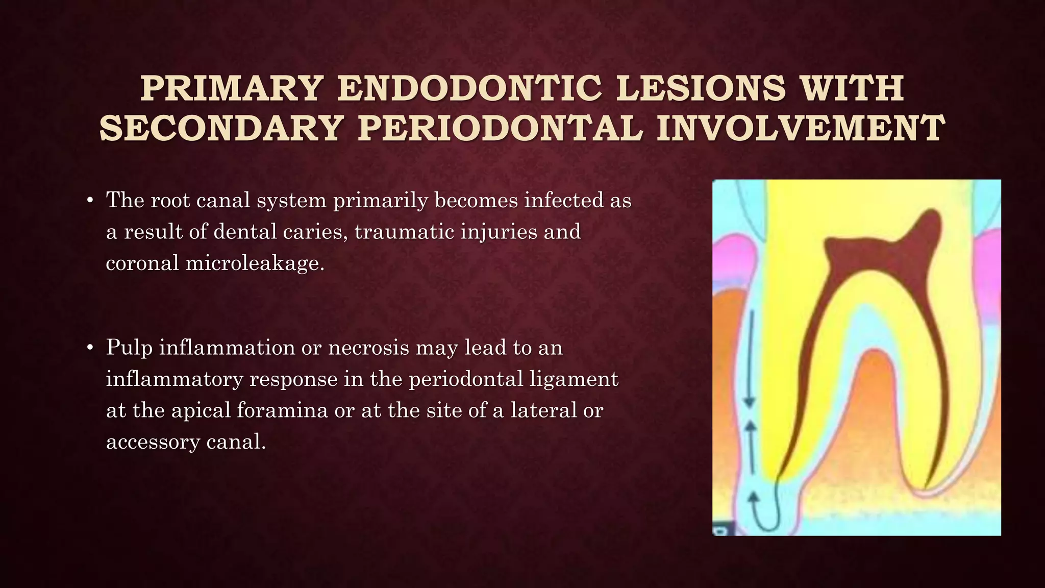 Endo-Perio Lesions | PPTX