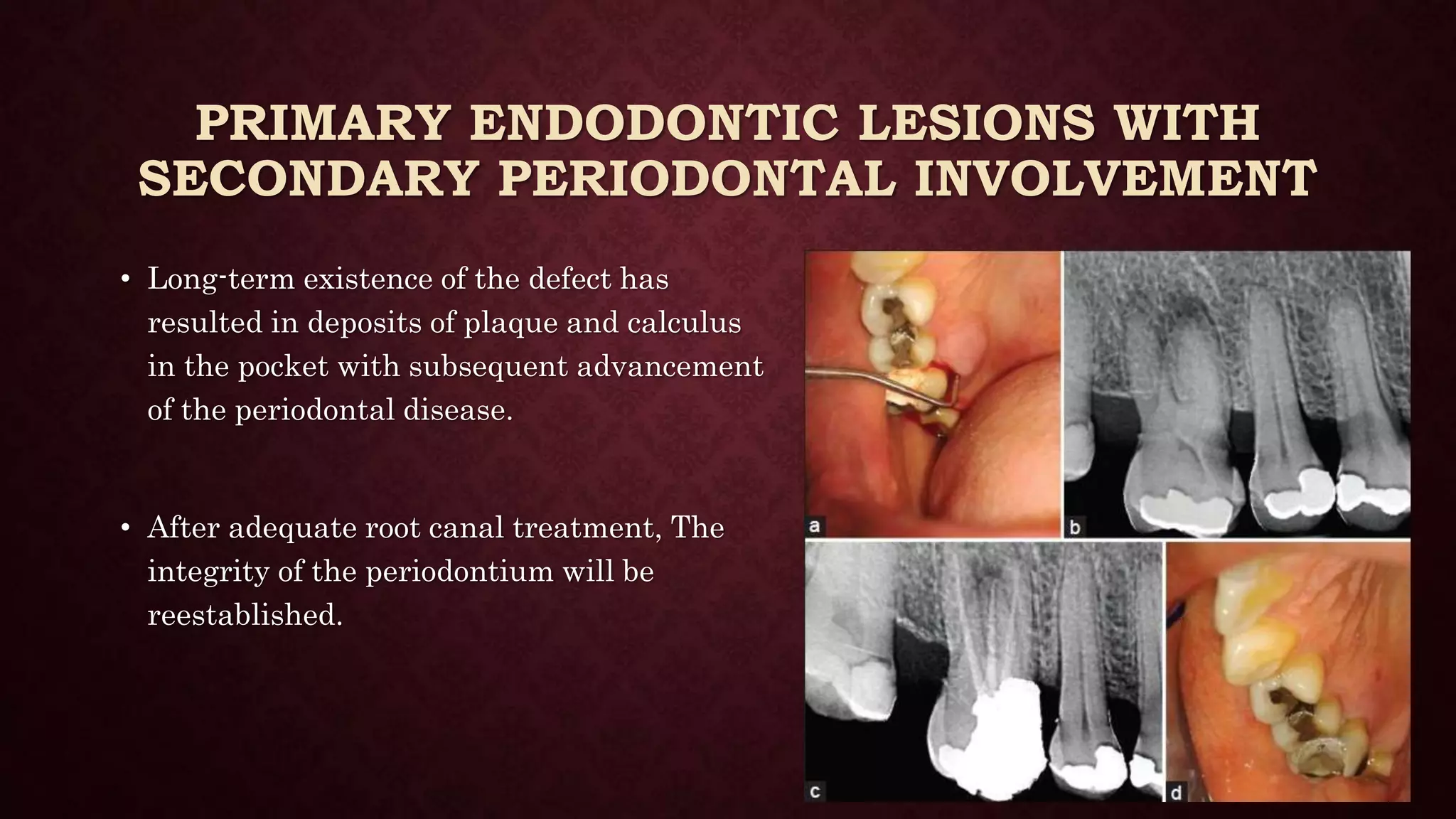 Endo-Perio Lesions | PPTX