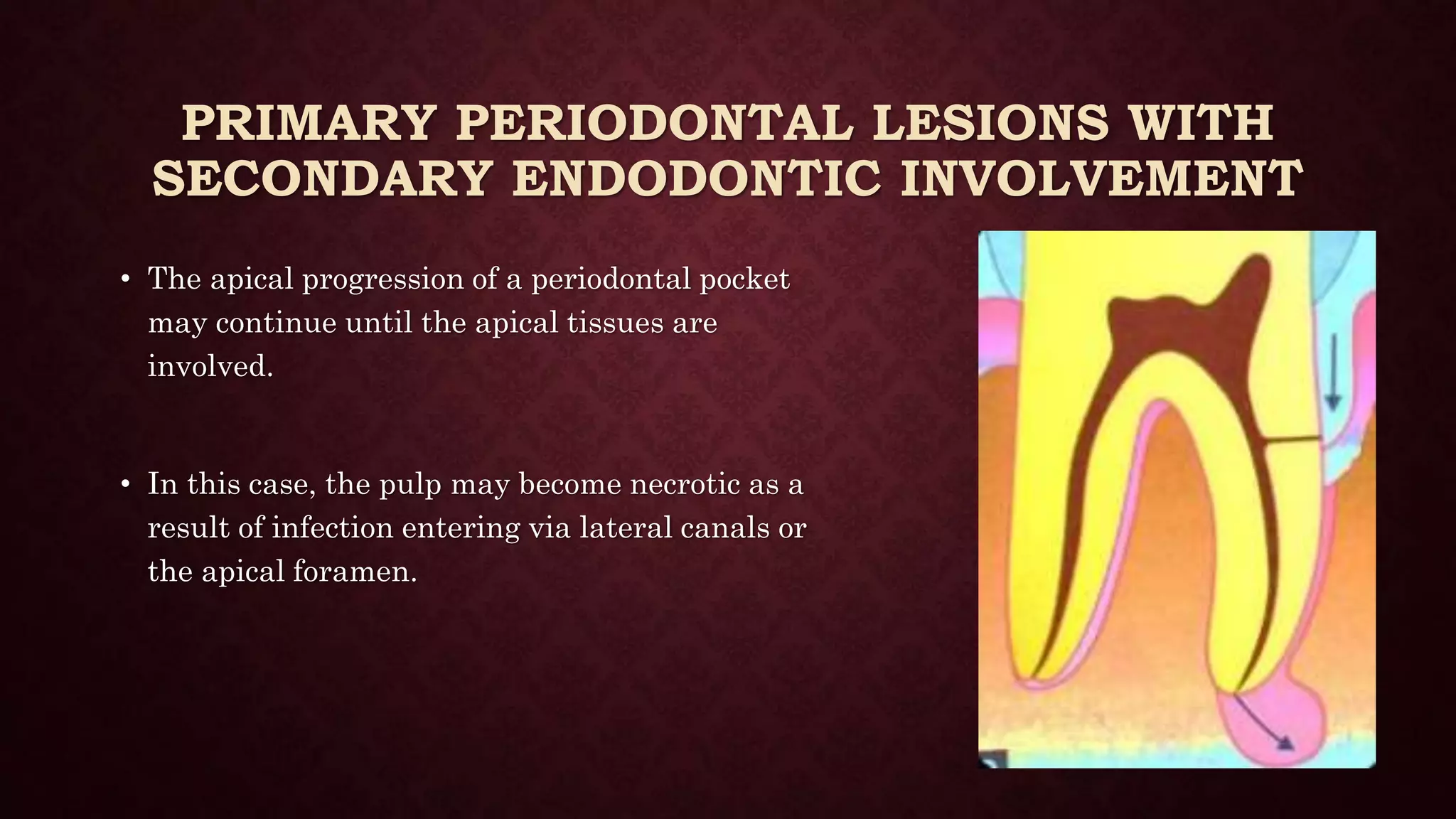 Endo-Perio Lesions | PPTX
