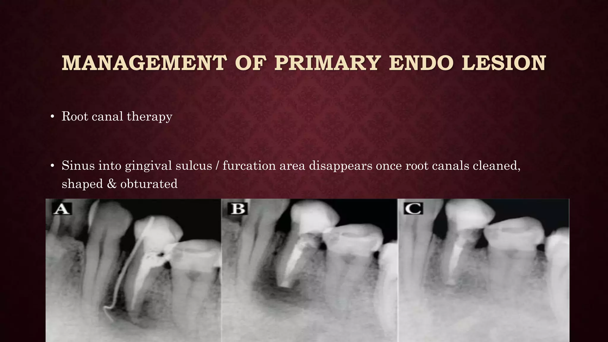 Endo-Perio Lesions | PPTX