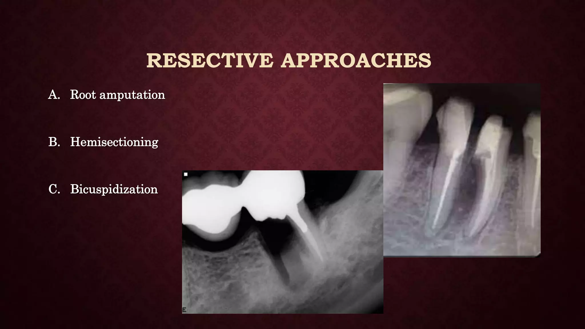Endo-Perio Lesions | PPTX