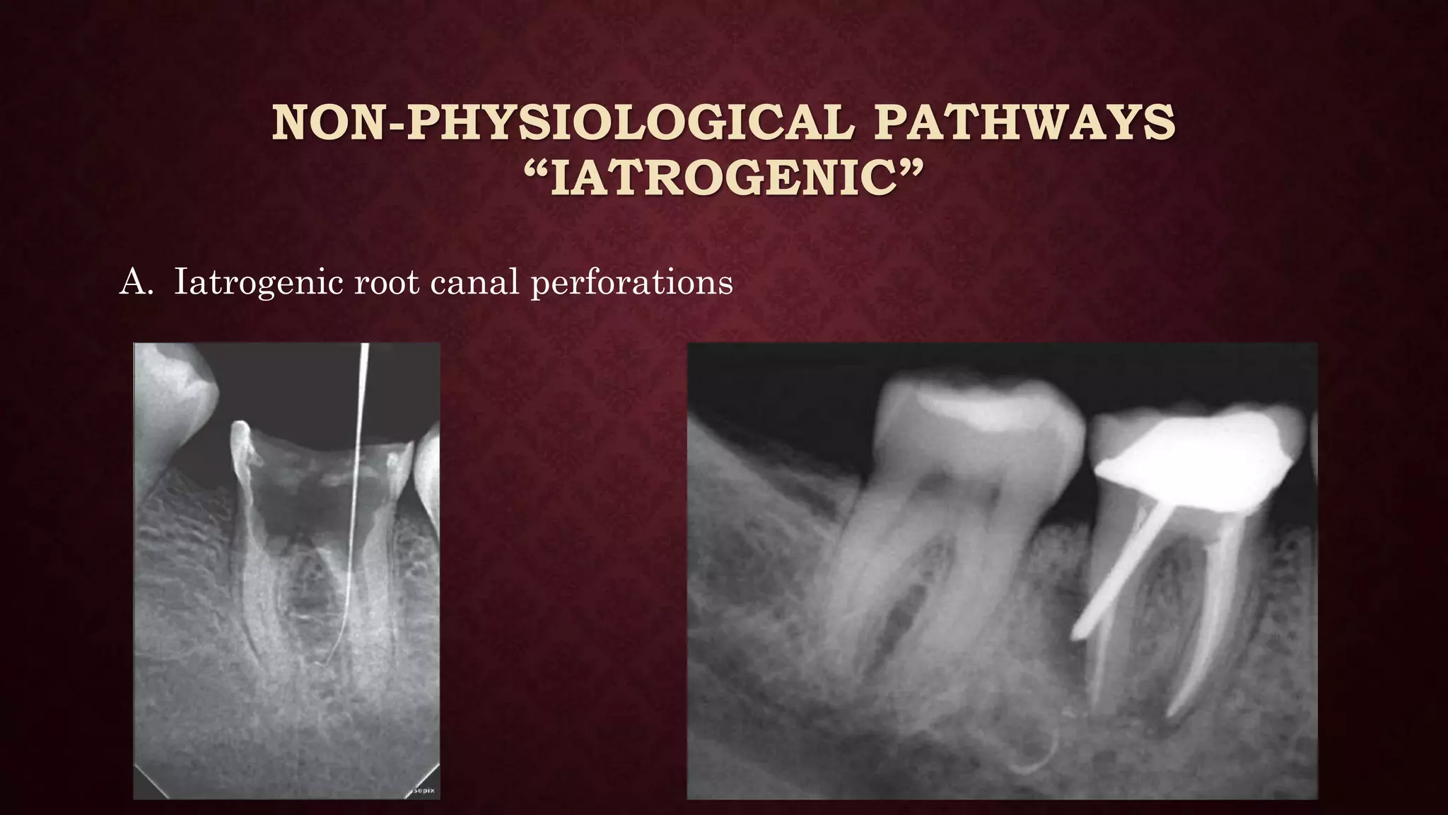 Endo-Perio Lesions | PPTX