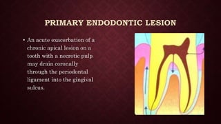 Endo-Perio Lesions | PPTX
