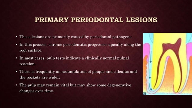 Endo-Perio Lesions | PPTX