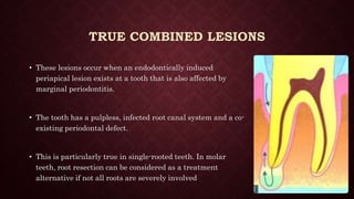 Endo-Perio Lesions | PPTX