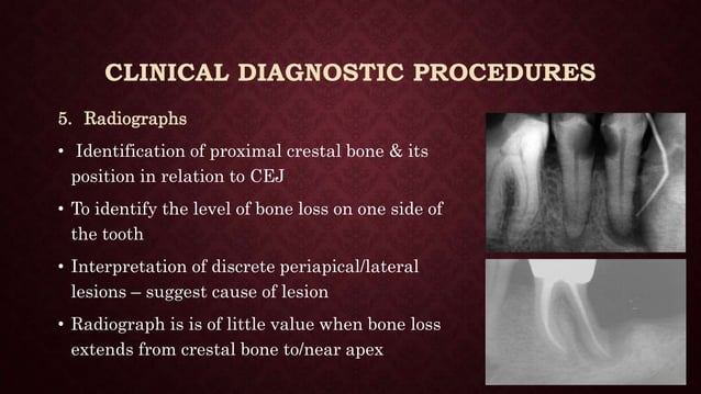 Endo-Perio Lesions | PPTX
