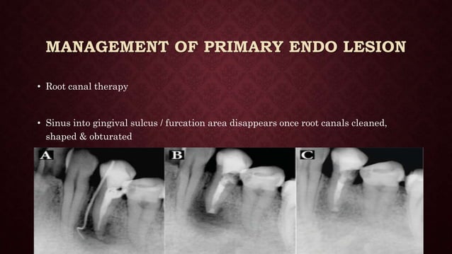 Endo-Perio Lesions | PPTX