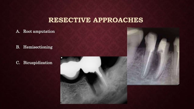 Endo-Perio Lesions | PPTX
