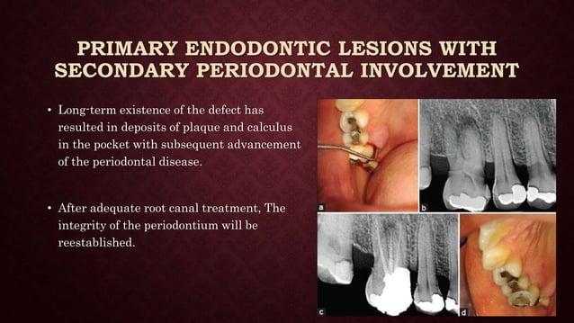 Endo-Perio Lesions