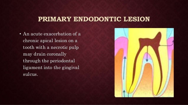 Endo-Perio Lesions