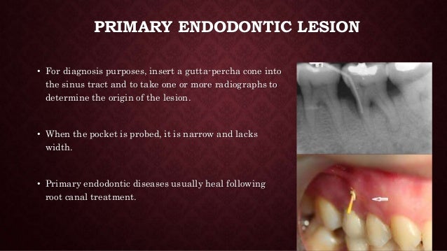 Endo-Perio Lesions