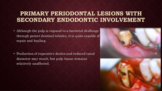 Endo-Perio Lesions