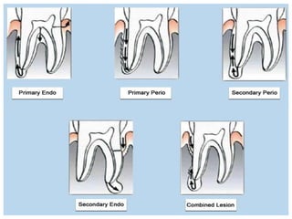 PERIO-ENDO LESIONS.pptx | Dental Health | Diseases and Conditions