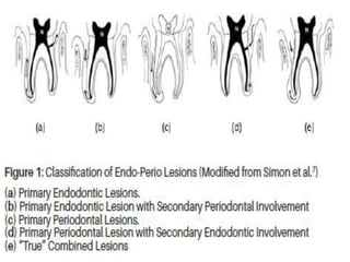 PERIO-ENDO LESIONS.pptx | Dental Health | Diseases and Conditions