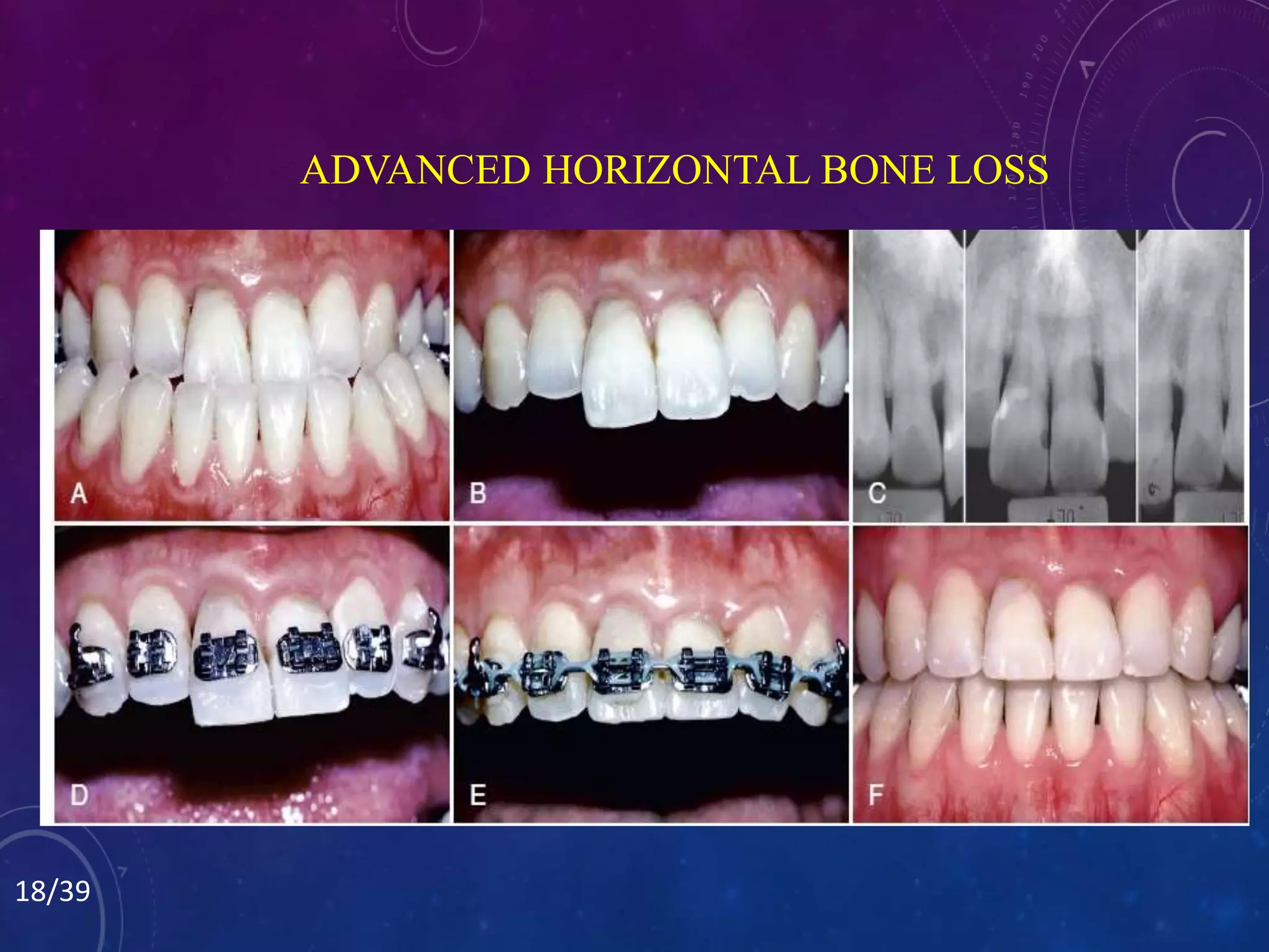 Perio-Ortho interrelationships - Dr.Malvika | PPTX