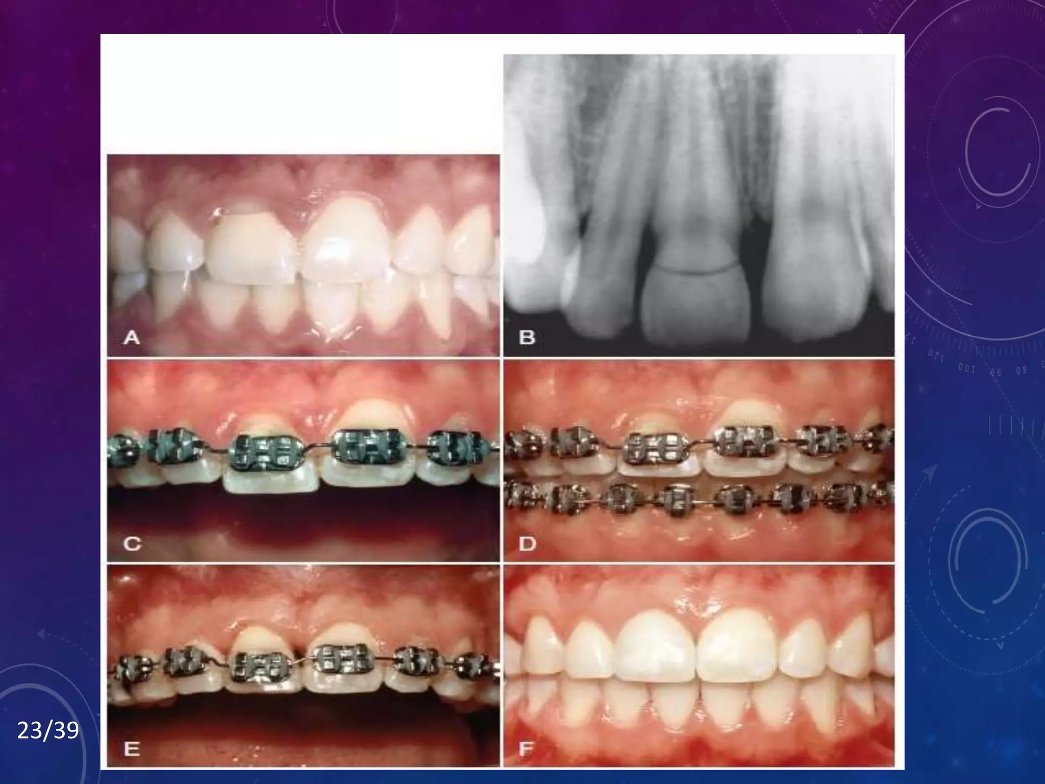 Perio-Ortho interrelationships - Dr.Malvika | PPTX
