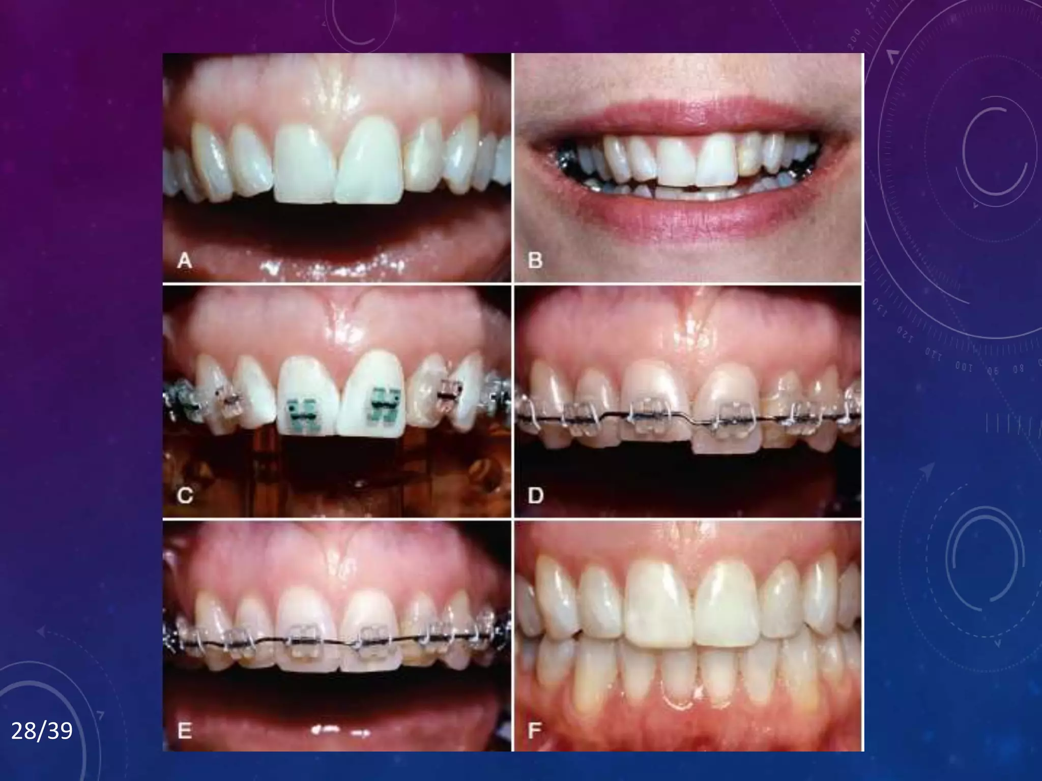 Perio-Ortho interrelationships - Dr.Malvika | PPTX