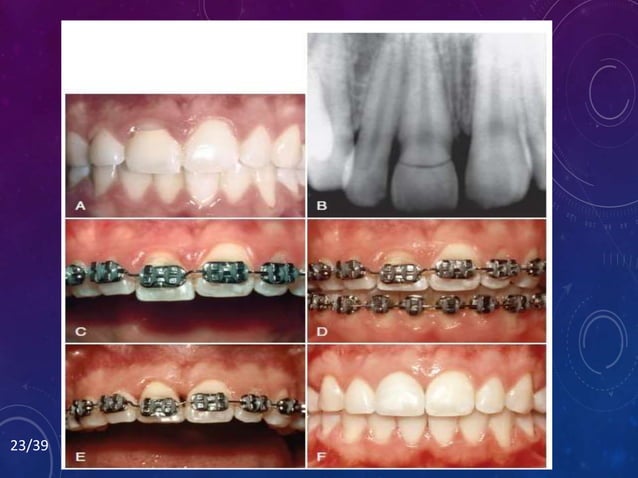 Perio-Ortho interrelationships - Dr.Malvika | PPTX | Oral care ...