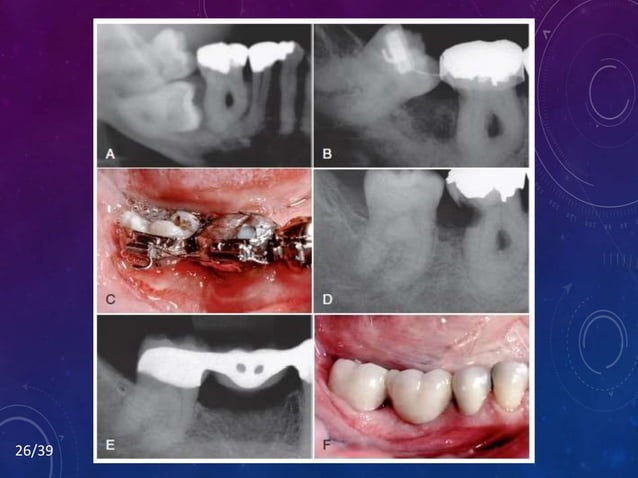 Perio-Ortho interrelationships - Dr.Malvika | PPTX | Oral care ...