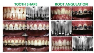 Perio ortho relationship | PPTX