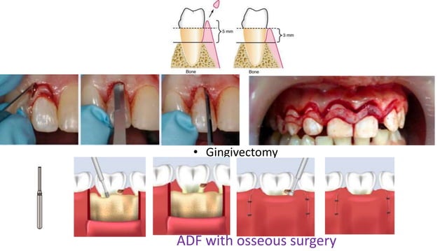 Perio resorative inter-relationship. | PPTX | Oral care | Personal Care