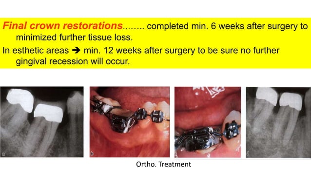 Perio resorative inter-relationship. | PPTX | Oral care | Personal Care