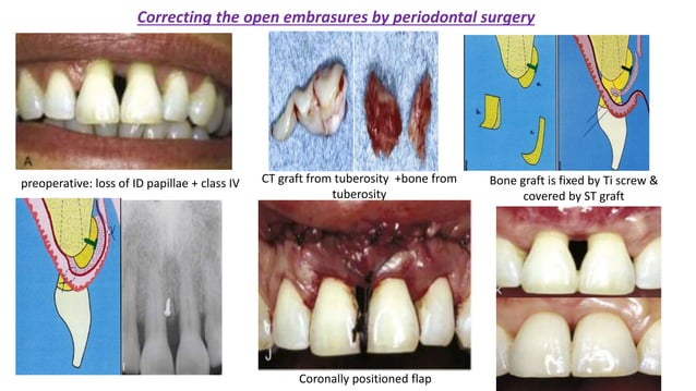 Perio resorative inter-relationship. | PPTX | Oral care | Personal Care