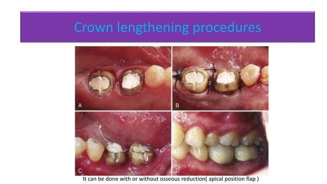 Perio resorative inter-relationship. | PPTX | Oral care | Personal Care