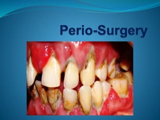Perio surgery | PPT