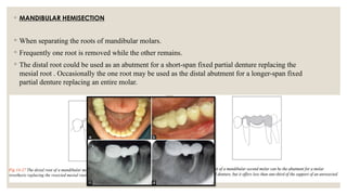 PERIO CONSIDERATIONS IN prosthodontics ppt | PPTX