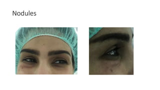 Periocualr Hyaloronic Acid Filler Complications | PPTX