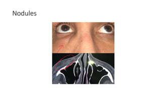 Periocualr Hyaloronic Acid Filler Complications | PPTX