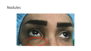 Periocualr Hyaloronic Acid Filler Complications | PPTX
