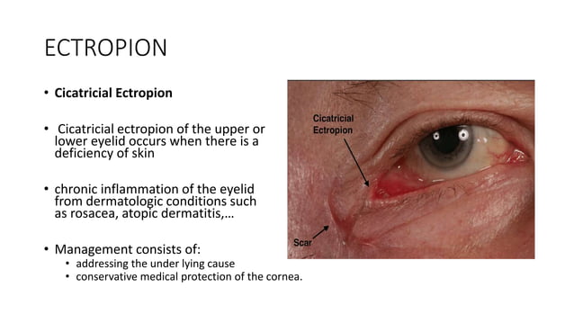 PERIOCULAR MALPOSITIONS AND INVOLUTIONAL CHANGES.pptx | Eye and Vision ...