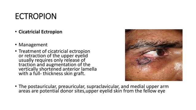 PERIOCULAR MALPOSITIONS AND INVOLUTIONAL CHANGES.pptx | Eye and Vision ...