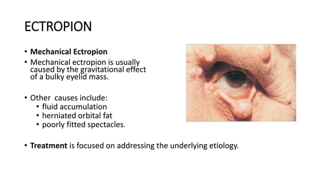 PERIOCULAR MALPOSITIONS AND INVOLUTIONAL CHANGES.pptx | Eye and Vision ...