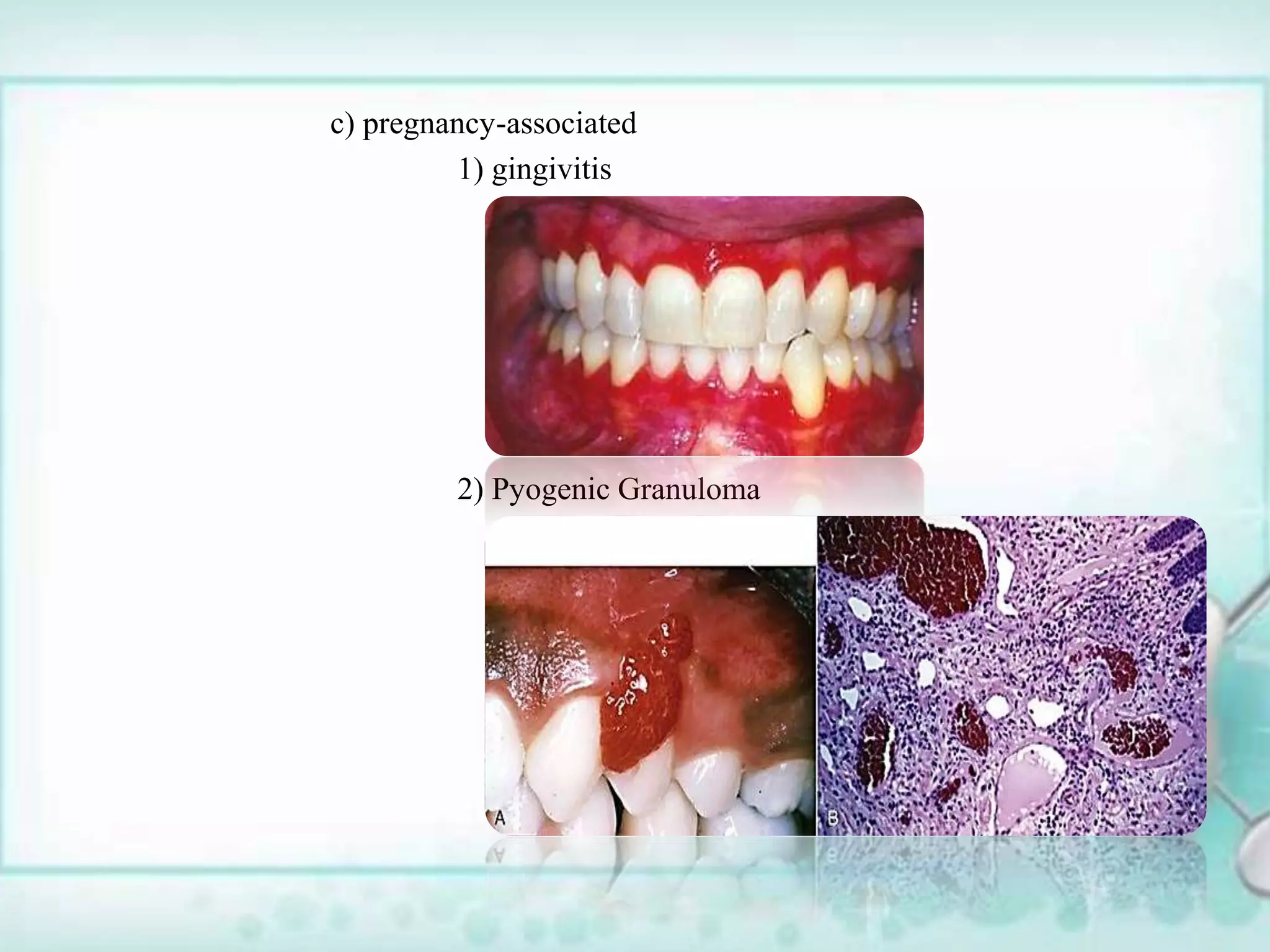 Classification of periodontal diseases and conditions past and present ...