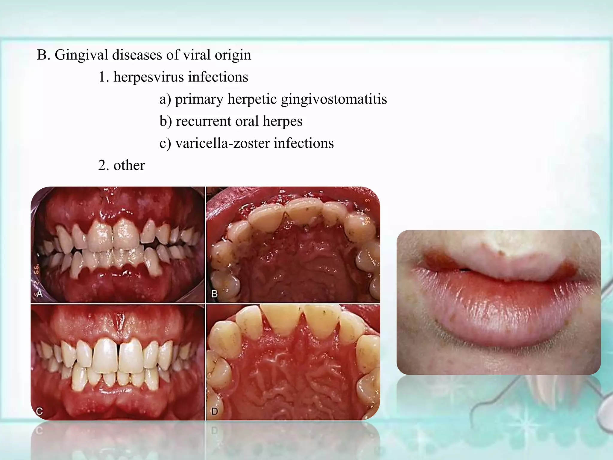Classification of periodontal diseases and conditions past and present ...