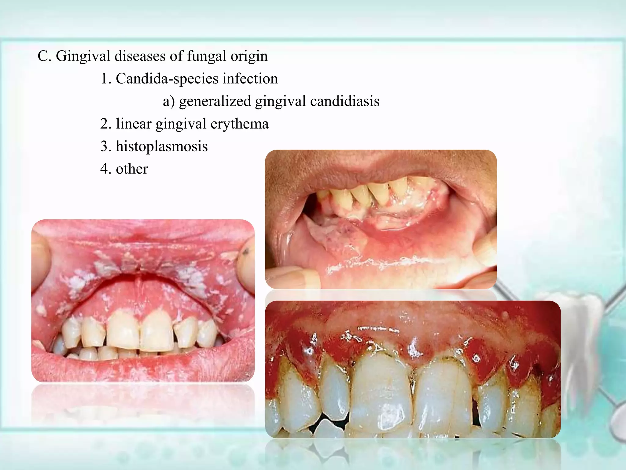 Classification of periodontal diseases and conditions past and present ...