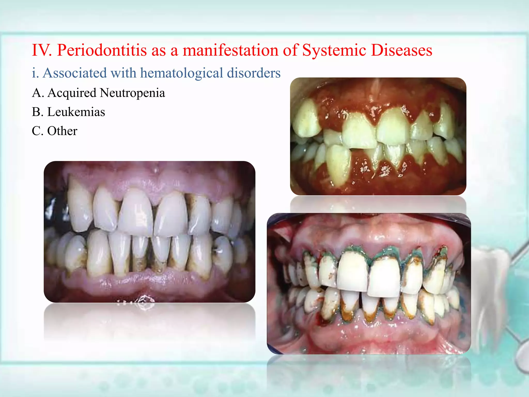 Classification of periodontal diseases and conditions past and present ...