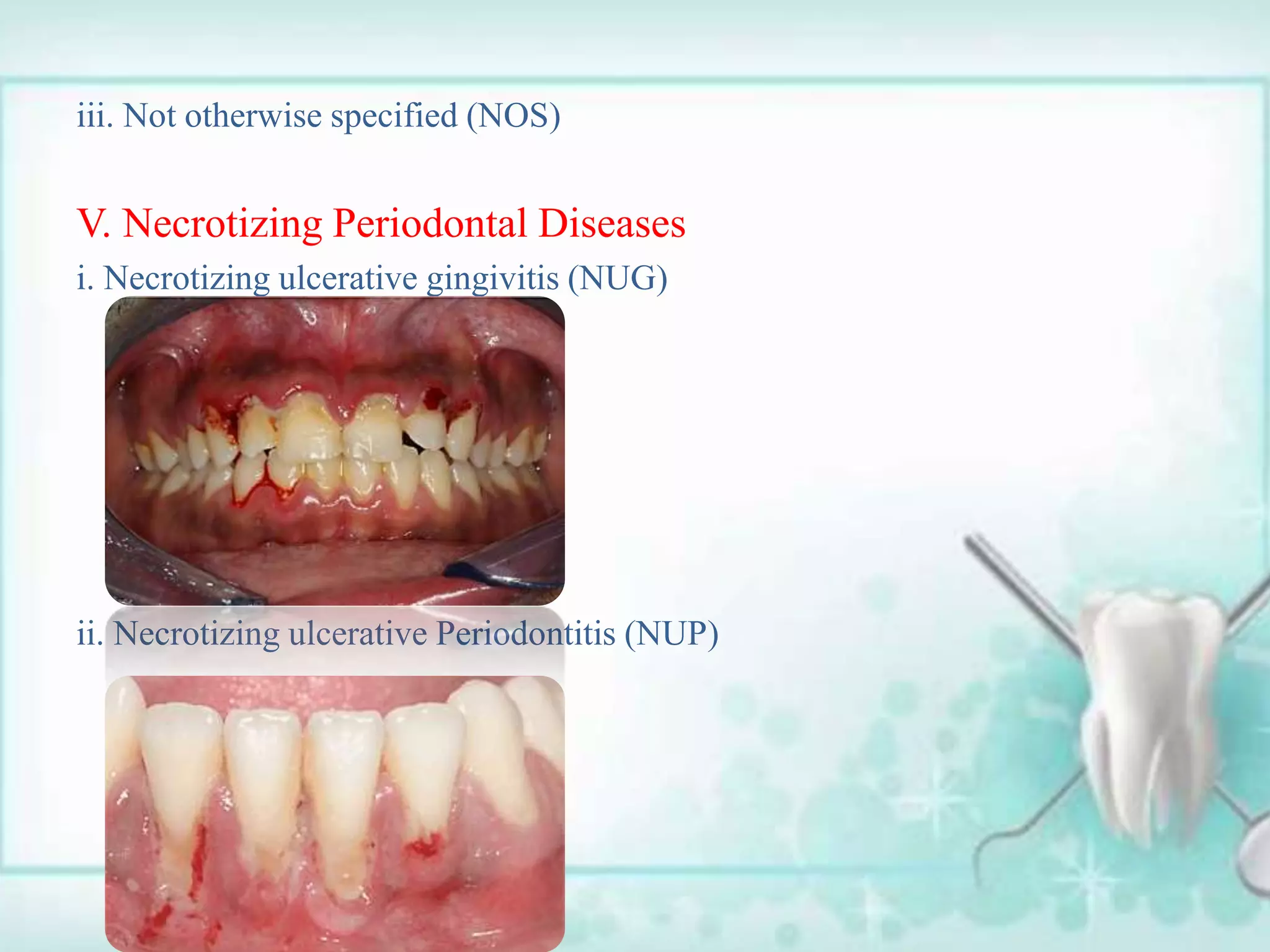 Classification of periodontal diseases and conditions past and present ...
