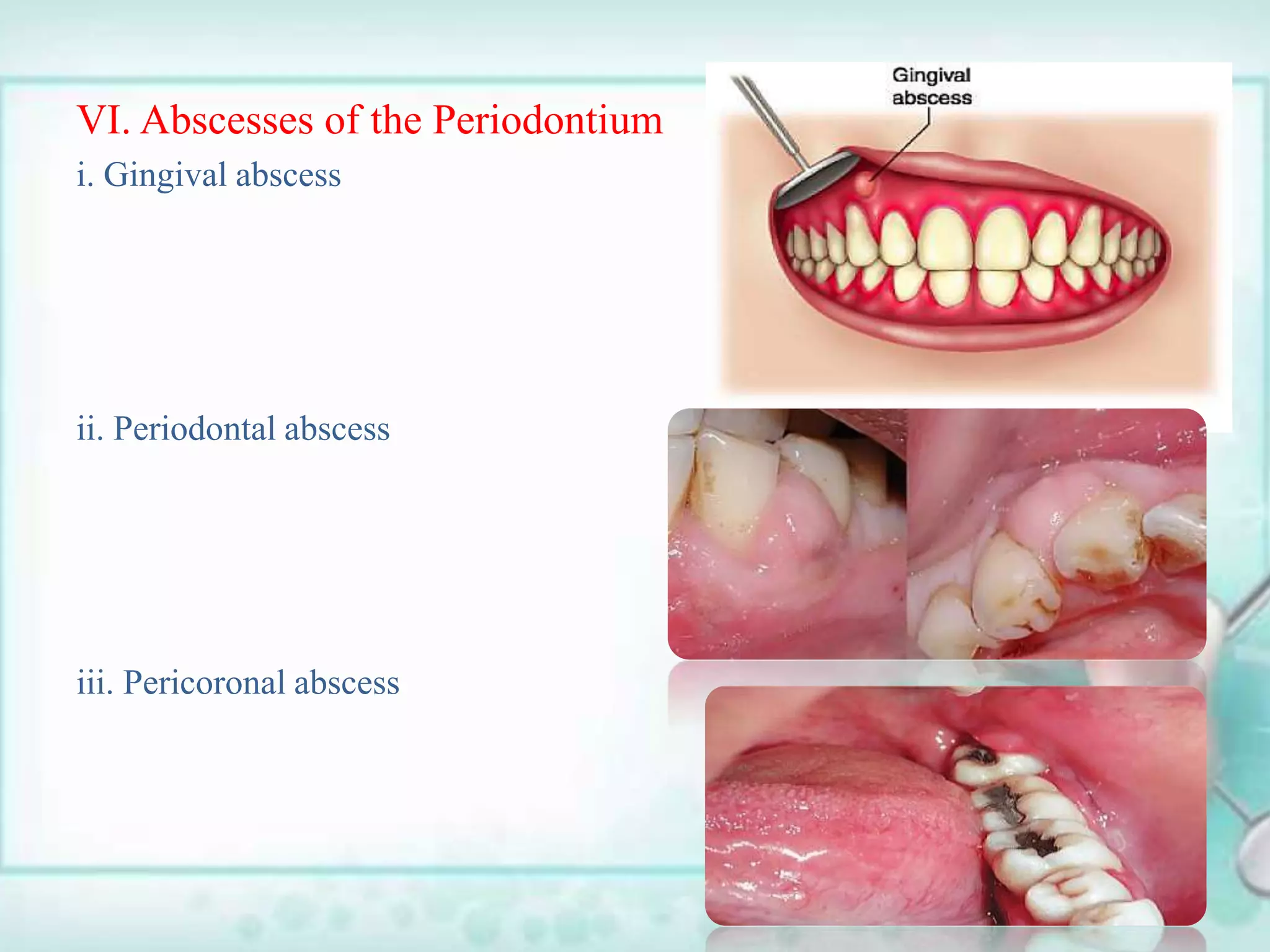 Classification of periodontal diseases and conditions past and present ...