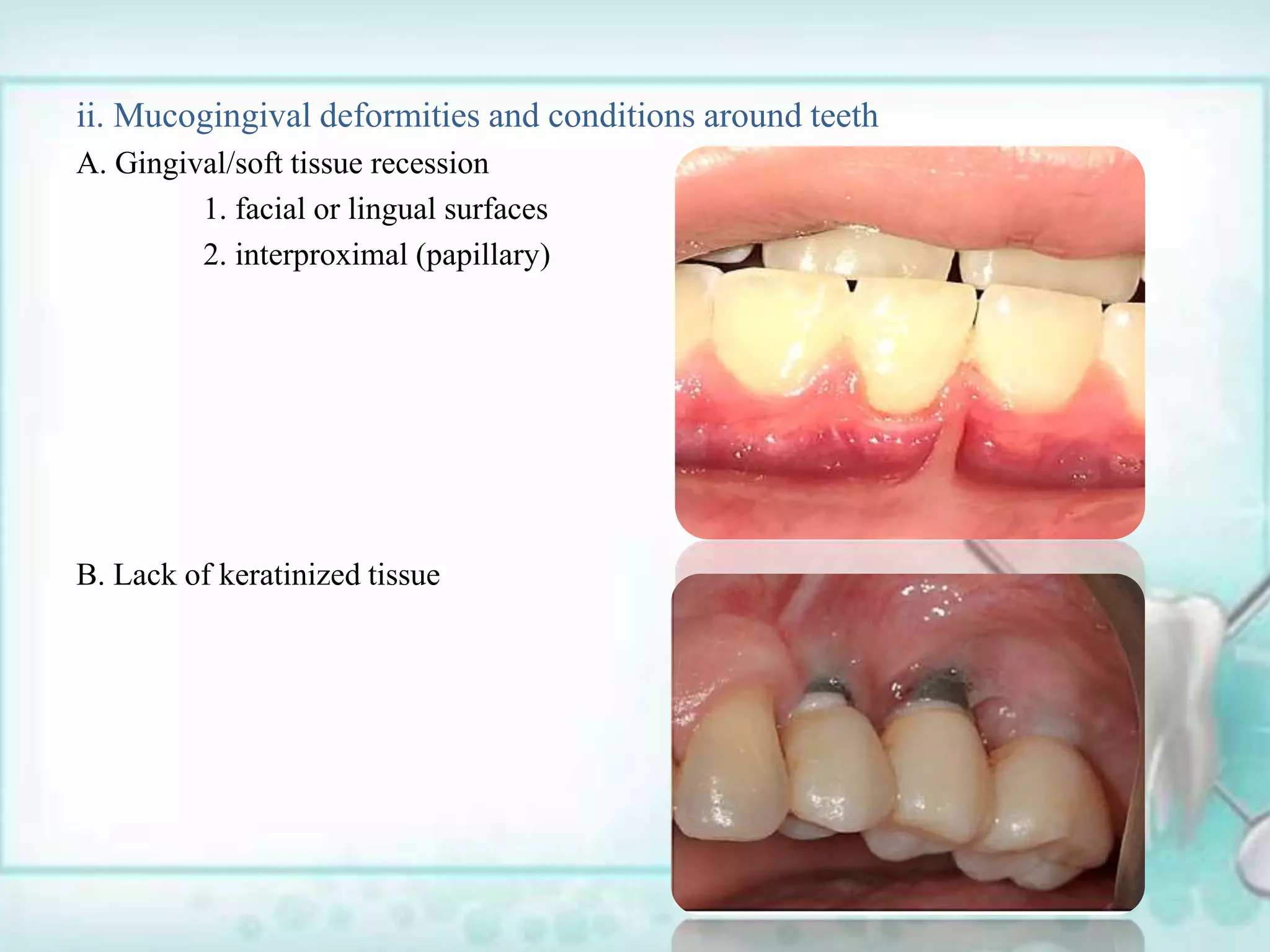 Classification of periodontal diseases and conditions past and present ...