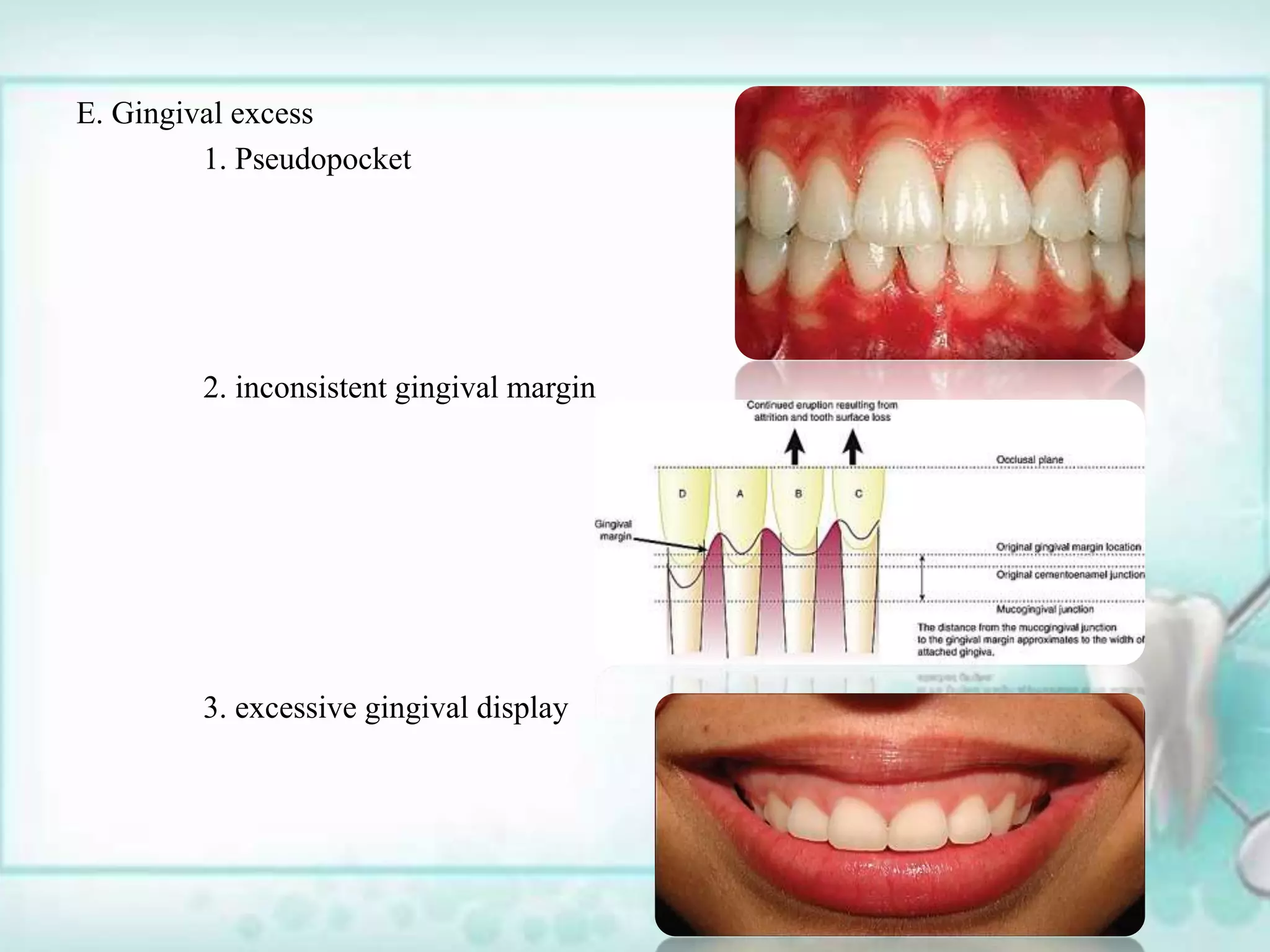 Classification of periodontal diseases and conditions past and present ...