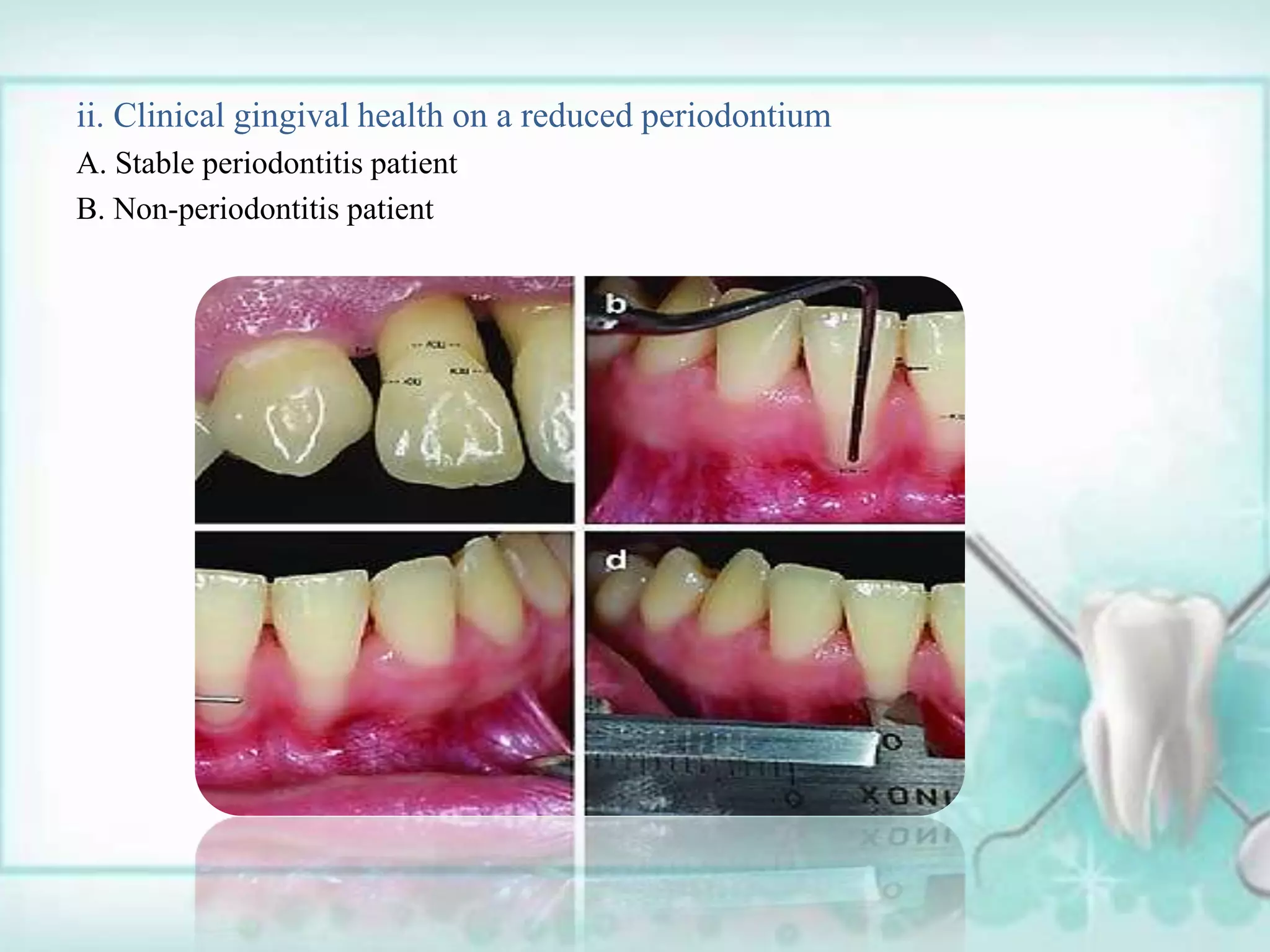 Classification of periodontal diseases and conditions past and present ...