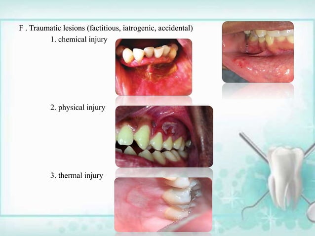 Classification of periodontal diseases and conditions past and present ...