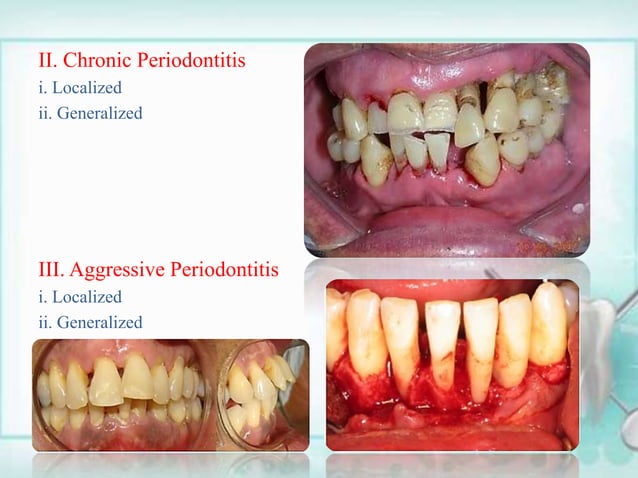 Classification of periodontal diseases and conditions past and present ...