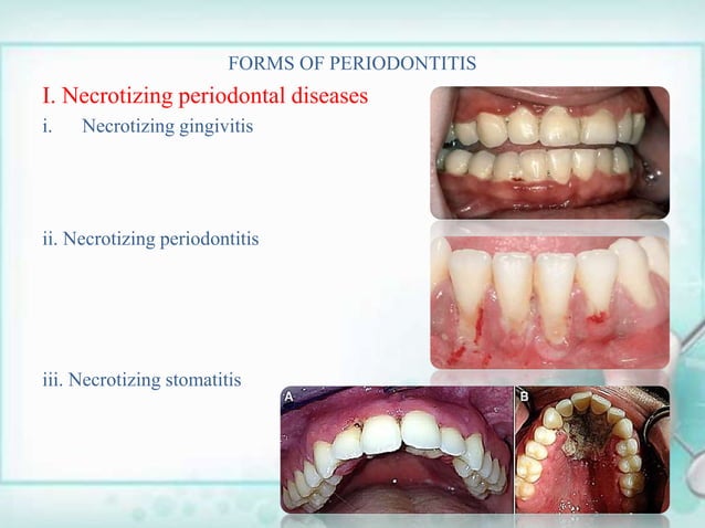 Classification of periodontal diseases and conditions past and present ...