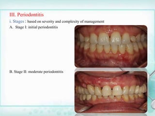Classification of periodontal diseases and conditions past and present ...
